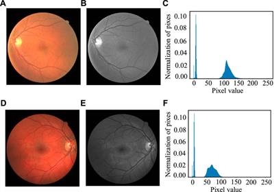 Frontiers | Retinal Vessel Segmentation Algorithm Based on Residual Convolution Neural Network